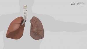 Pneumonectomy | Thoracic Surgery University Hospitals Birmingham